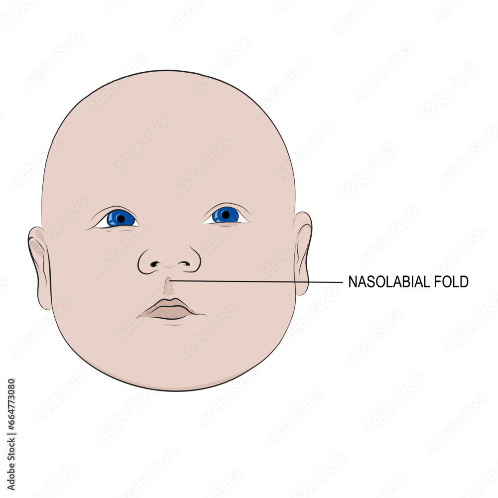Nasolabial fold or nasolabial fold the line that descends from the wing ...