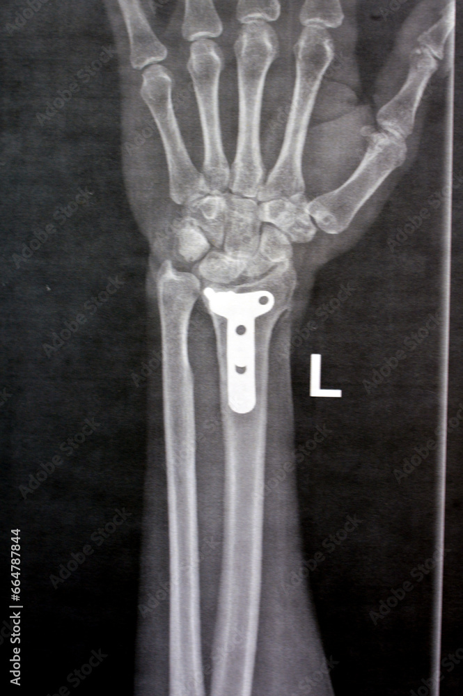 Plain x ray showing a recent fissure fracture at the lower part of a ...
