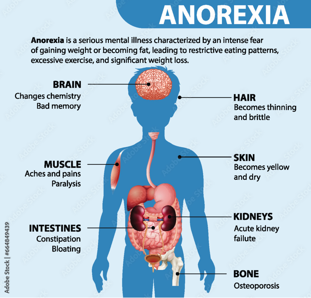 Effects of Anorexia on Male Anatomy Stock Vector | Adobe Stock