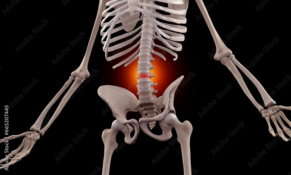 Medical illustration of human skeleton with lumbar fracture injury ...