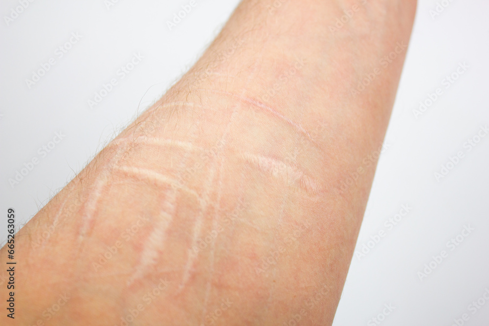 Scars from cuts on the arm. Old traces of a skin cut on the forearm ...
