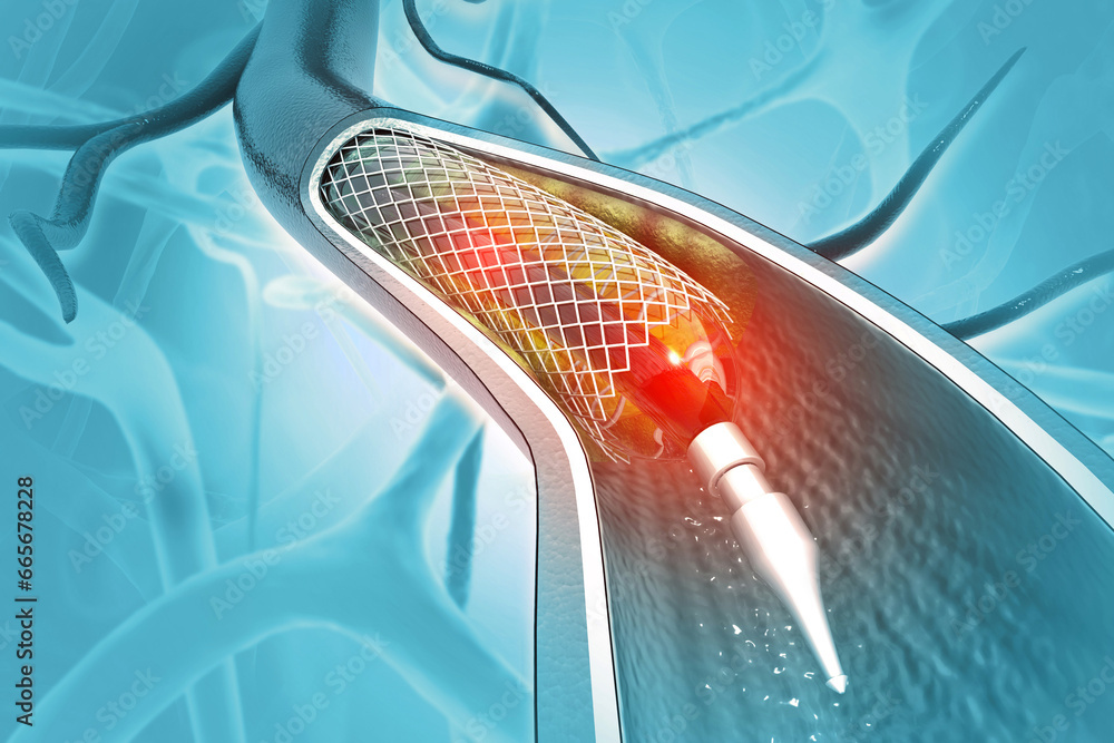 Poster Balloon angioplasty procedure to expanded artery for blood flow ...