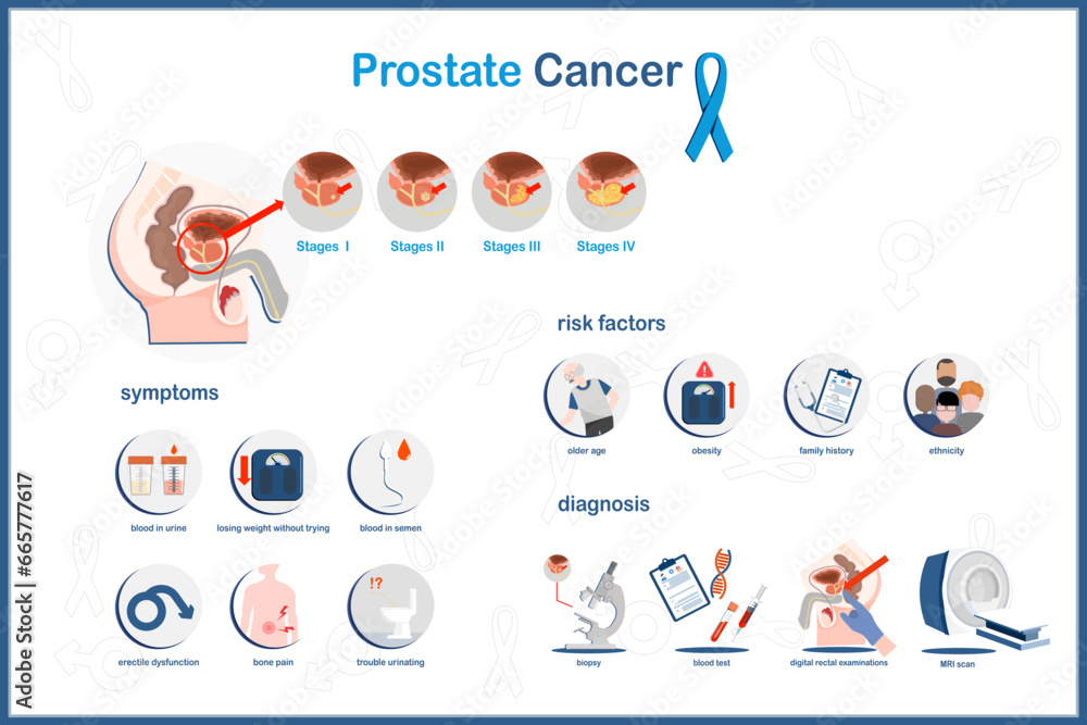 Flat Vector Concept Medical Infographic Illustration Of Prostate Cancer