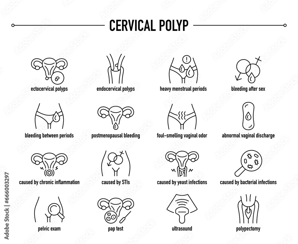 Cervical Polyp symptoms, diagnostic and treatment vector icons. Line ...