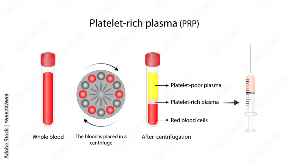 Platelet-rich plasma (prp). Autologous conditioned plasma, is a ...