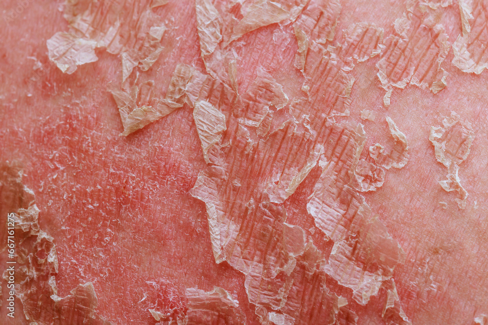 Sunburn can lead to irritated reddened skin shedding of cell scales on ...