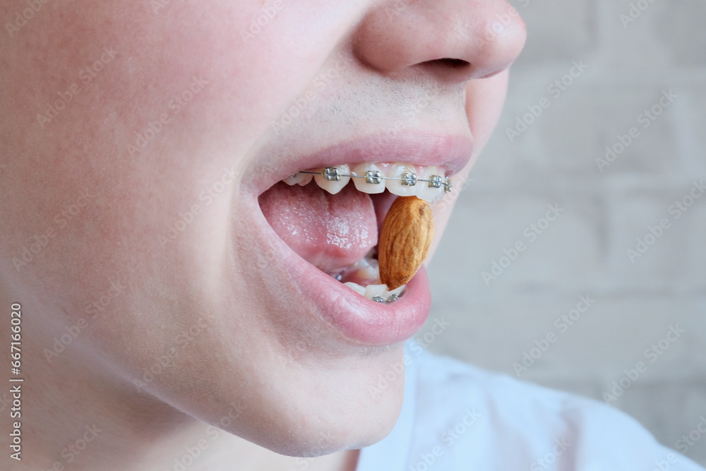 Teenager young man, European, close-up of braces on his teeth. Biting ...