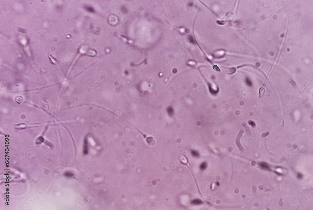 Semen analysis. Normozoospermia analyzed by microscope. Normal sperm ... Semen analysis. Normozoospermia analyzed by microscope. Normal sperm ...