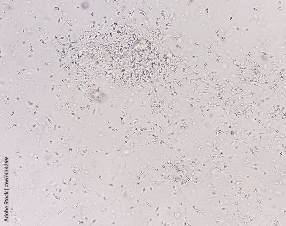 Semen analysis. Normozoospermia analyzed by microscope. Normal sperm ... Semen analysis. Normozoospermia analyzed by microscope. Normal sperm ...