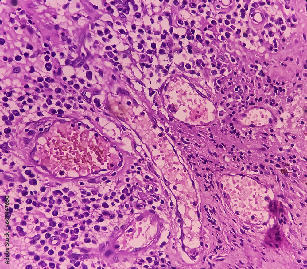 Ear (biopsy): Microphotograph of Granulation tissues, show dense ...