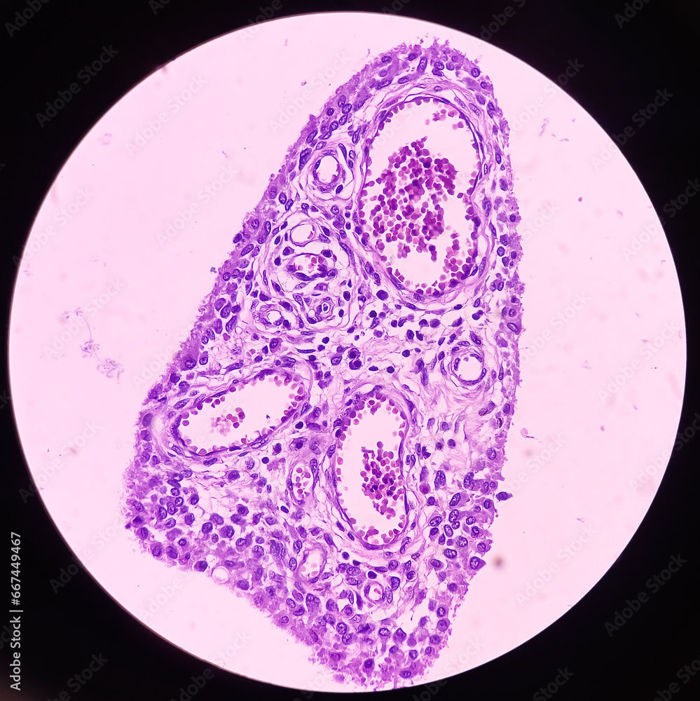 Synovial tissue (biopsy): Villonodular synovitis. Ganglion cells, smear ...