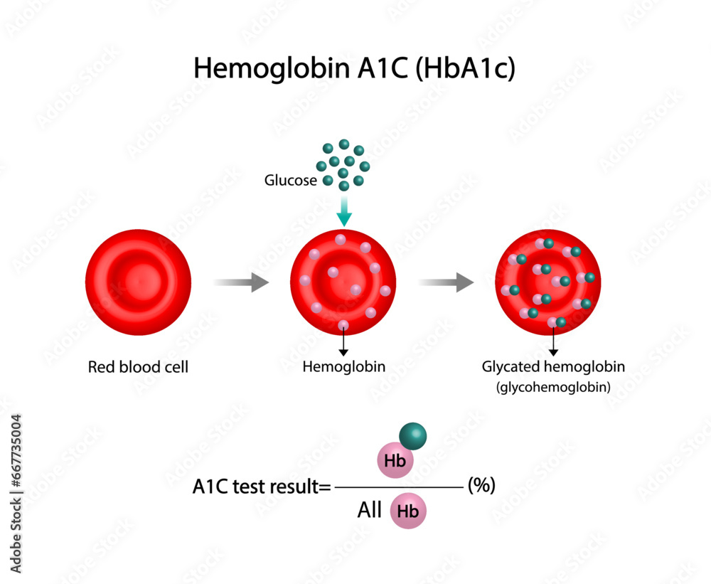 Hemoglobin A1C, HbA1c test , HbA1c levels, Glucose sticks to hemoglobin ...