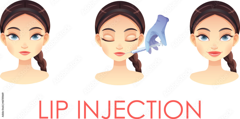 Vector cartoon illustration of beauty procedures, lip augmentation with ...