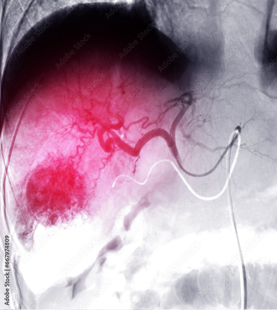 Transarterial Chemoembolization (TACE) is a medical procedure used to ...
