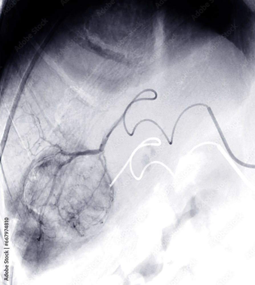 Poster Transarterial Chemoembolization (TACE) is a medical procedure ...