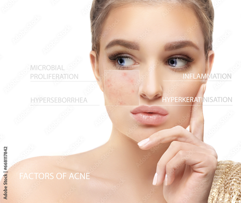 Factors of acne,.Acne Marks .Treating Acne Scars.Acne Scar Removal ...