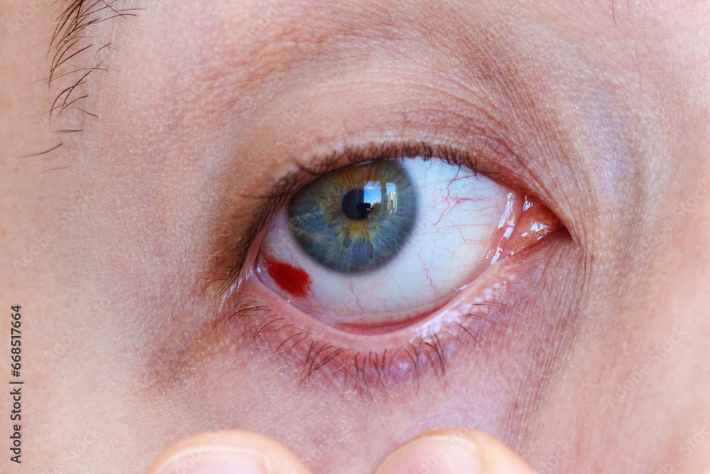 Close up of a bloodshot eye man. Hemorrhage of the eye, rupture of a ...