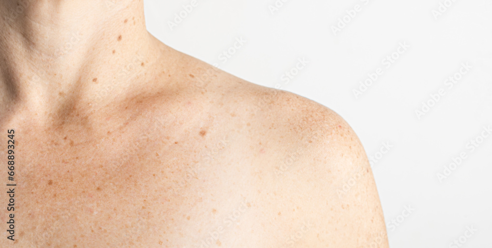 Upper torso of white woman with nevus, moles, spots on the skin ...