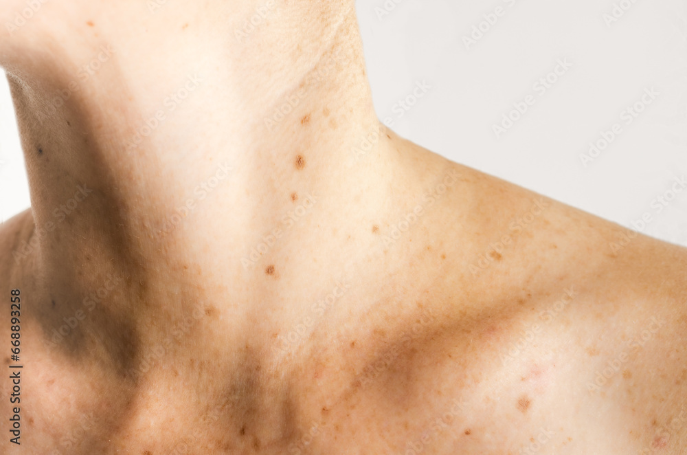 Upper torso of white woman with nevus, moles, spots on the skin ...