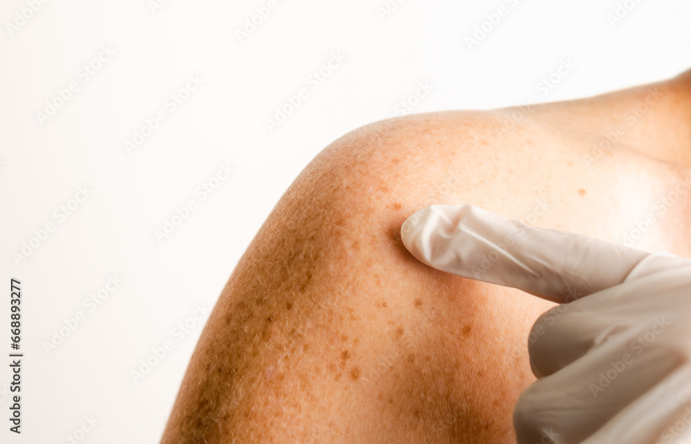Doctor with white glove pointing at shoulder of white woman with nevus ...