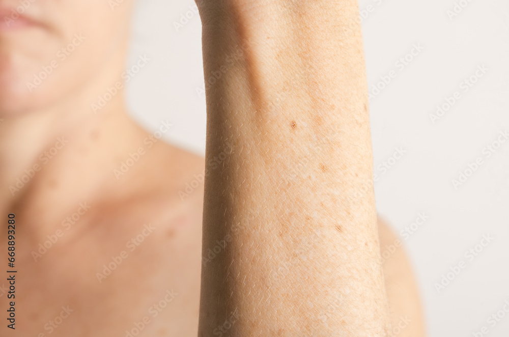 Forearm of white woman arm, nevus, moles, spots on the skin, isolated ...