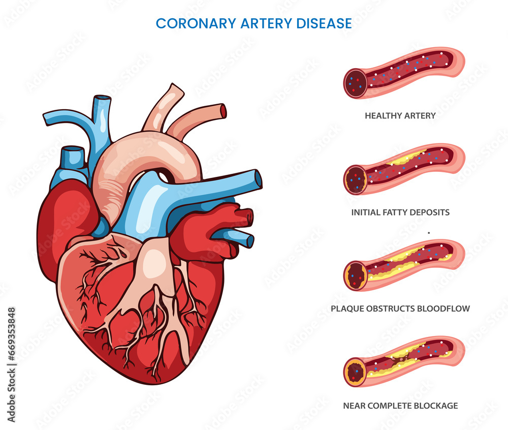 In Coronary artery disease heart arteries become narrow which reduced ...