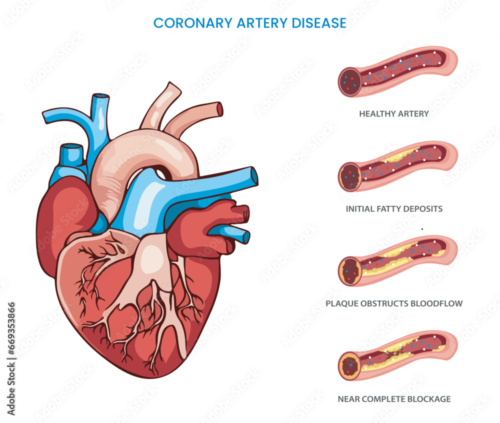 Coronary artery disease is a condition where the coronary arteries ...