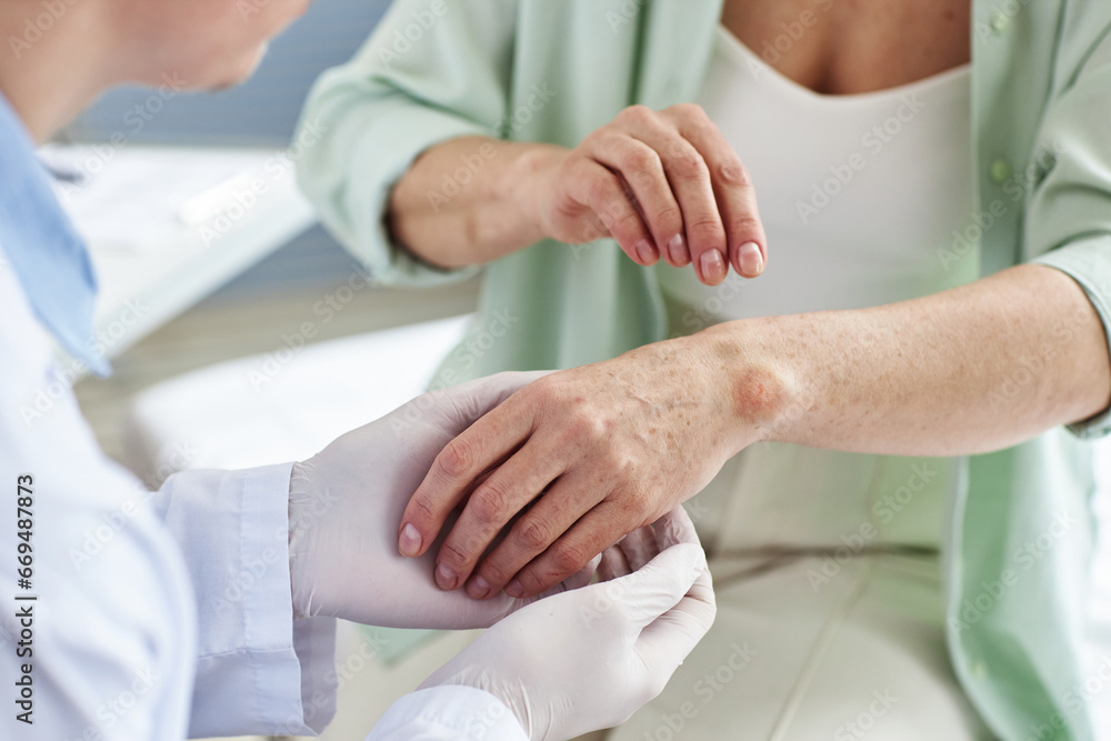 Closeup of doctor inspecting skin rash on hand of female patient in ...
