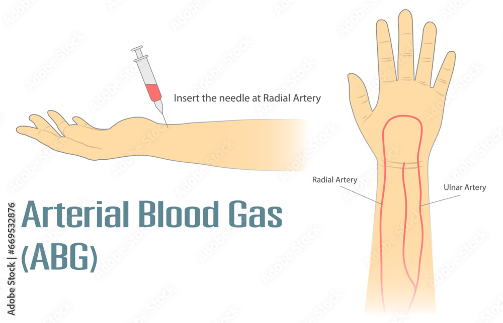 Arterial Blood Gas ABG test insert the needle at radial artery on wrist ...