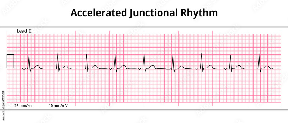 ECG Accelerated Junctional Rhythm - Escape Rhythm - 8 Second ECG Paper ...