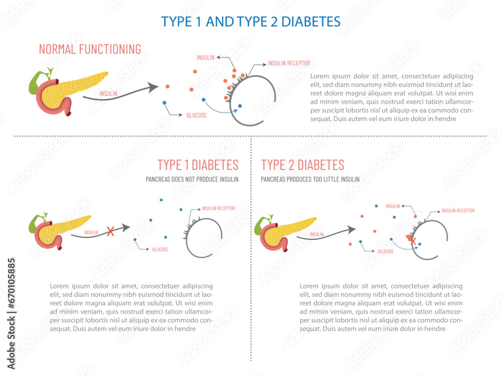 Type 1 and type 2 diabetes, how it occurs. Process from the pancreas to ...