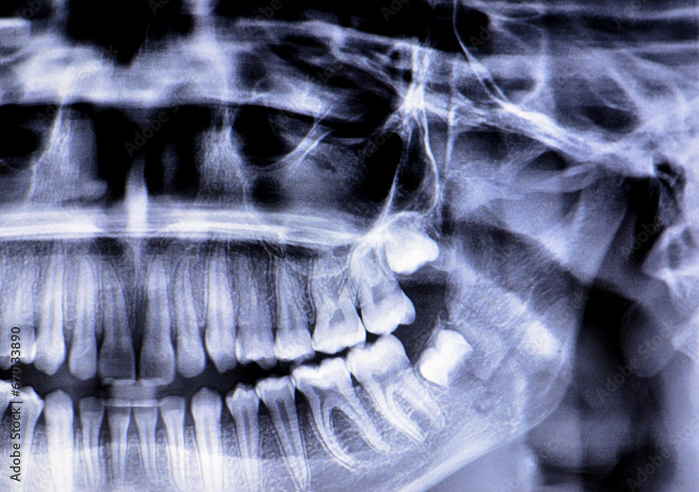 A panoramic radiograph of a girl fracture of the jawbone after a direct ...