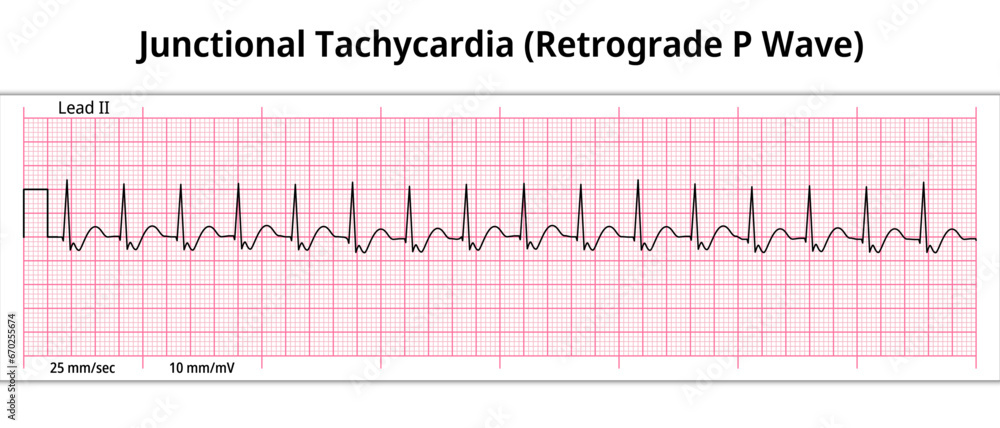 ECG Junctional Tachycardia - Retrograde P Wave - 8 Second ECG Paper ...