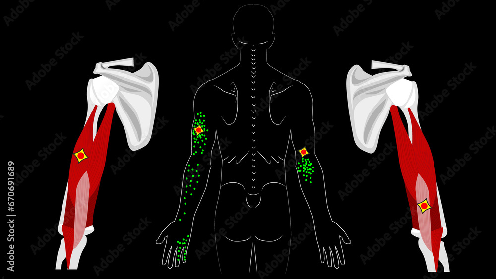 Triceps brachii muscle. Trigger points and referred pain Stock ...