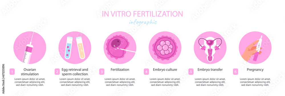 IVF infographic concept. Fertilization and ovulation. Reproductive ...