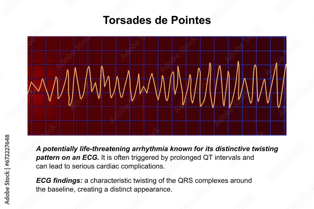 ECG displaying Torsades de pointes rhythm, 3D illustration Stock ...