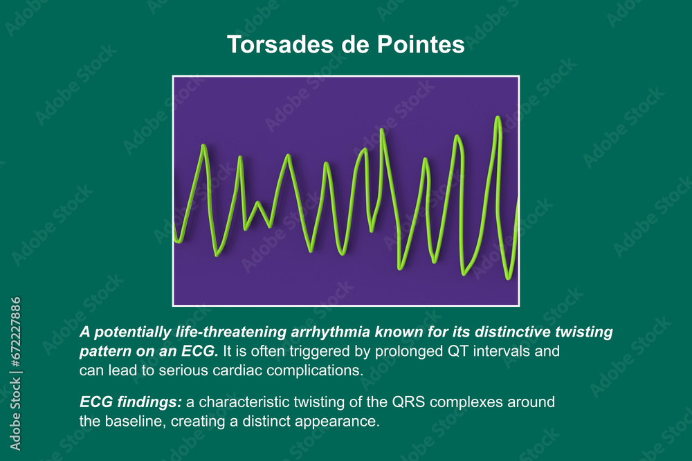 ECG displaying Torsades de pointes rhythm, 3D illustration Stock ...