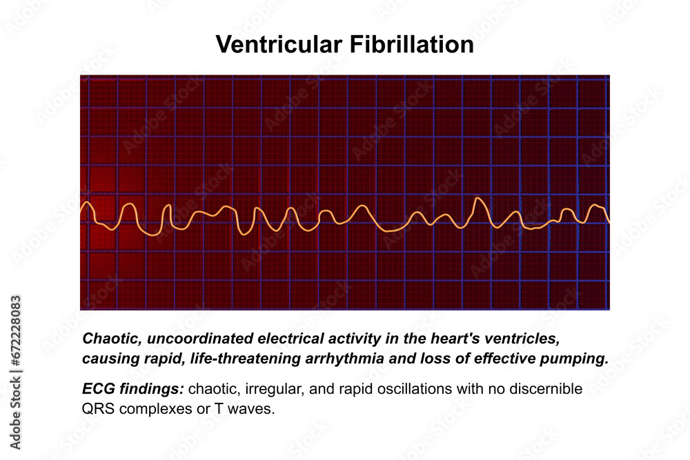 ECG displaying the chaotic rhythm of ventricular fibrillation, 3D ...