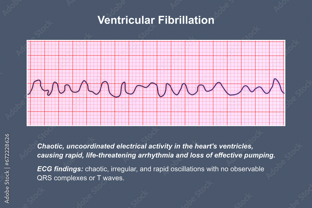 ECG displaying the chaotic rhythm of ventricular fibrillation, 3D ...