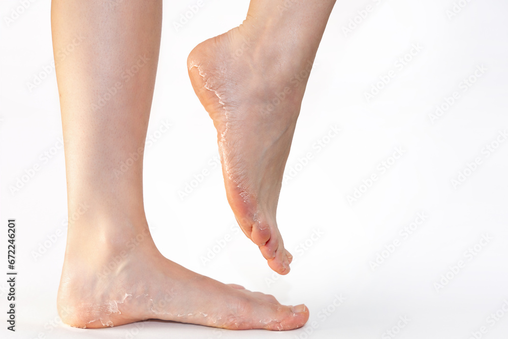 Side view of female legs with flaky skin heels. Copy space. White ...
