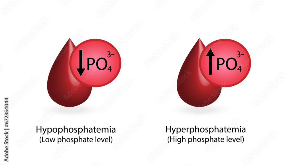 Hyperphosphatemia, high plasma phosphate level and Hypophosphatemia ...