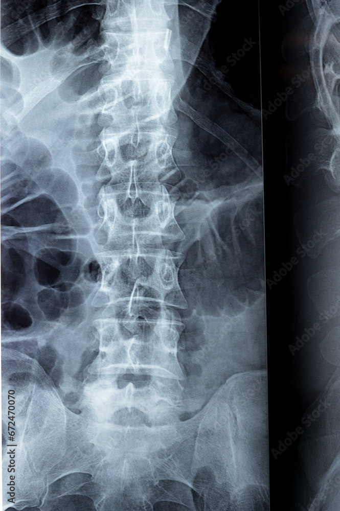 Lumbosacral spine digital radiographic examination reveals straightened ...