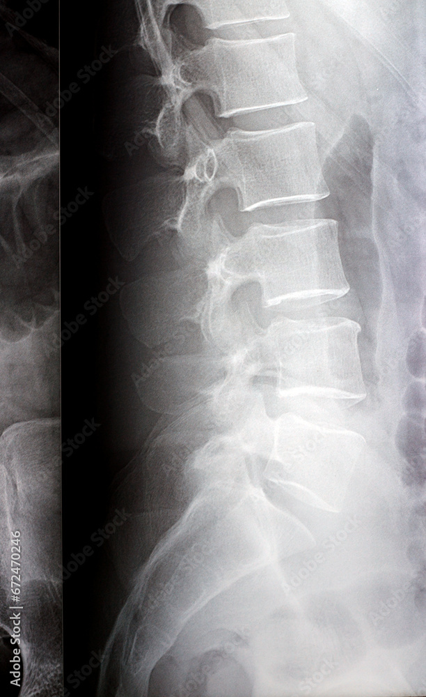 Lumbosacral spine digital radiographic examination reveals straightened ...
