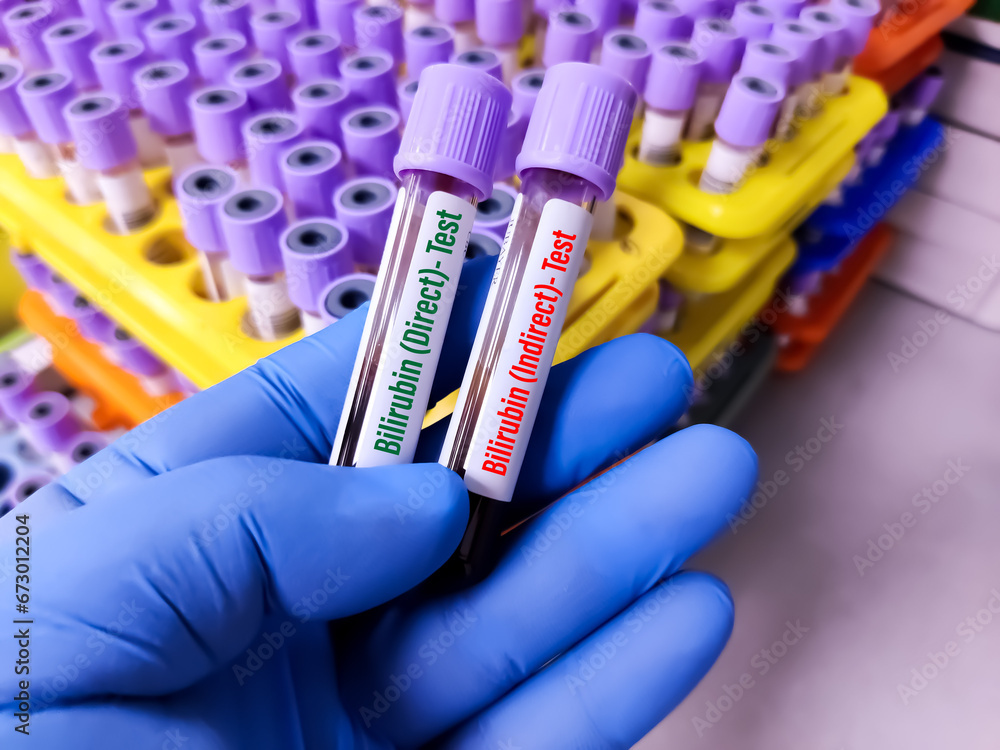 Blood sample for Bilirubin Direct and Indirect test. To diagnosis ...