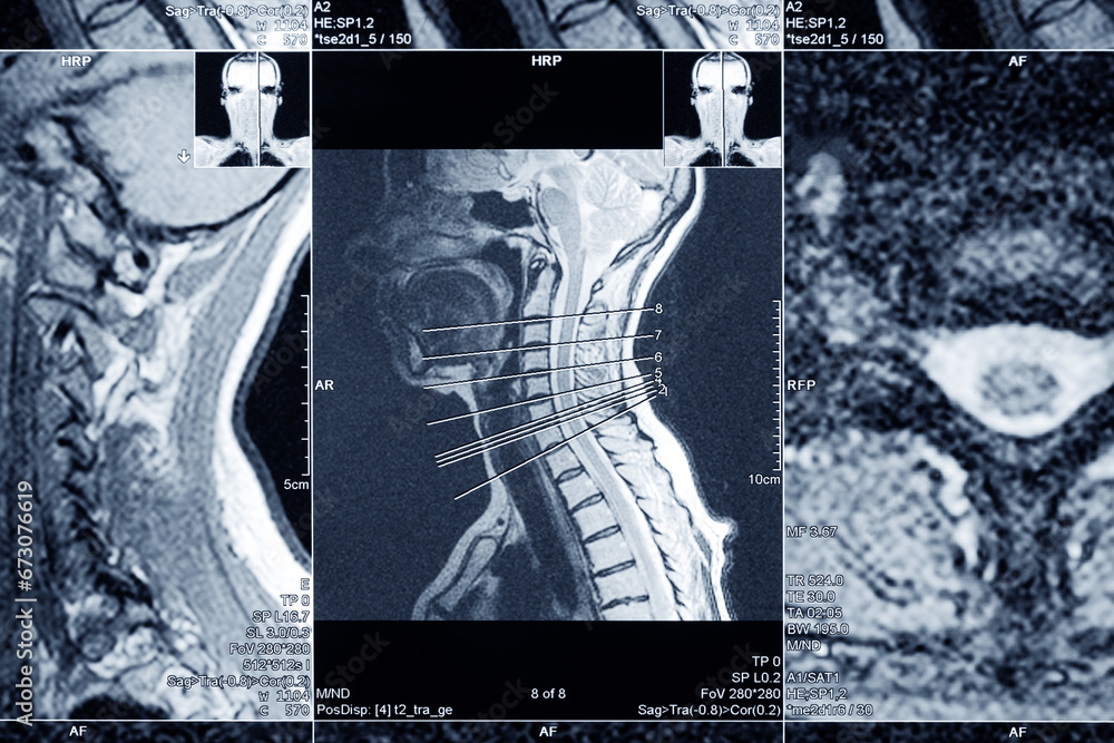 MRI scan of the cervical spine for diagnosis. Medical examination Stock ...