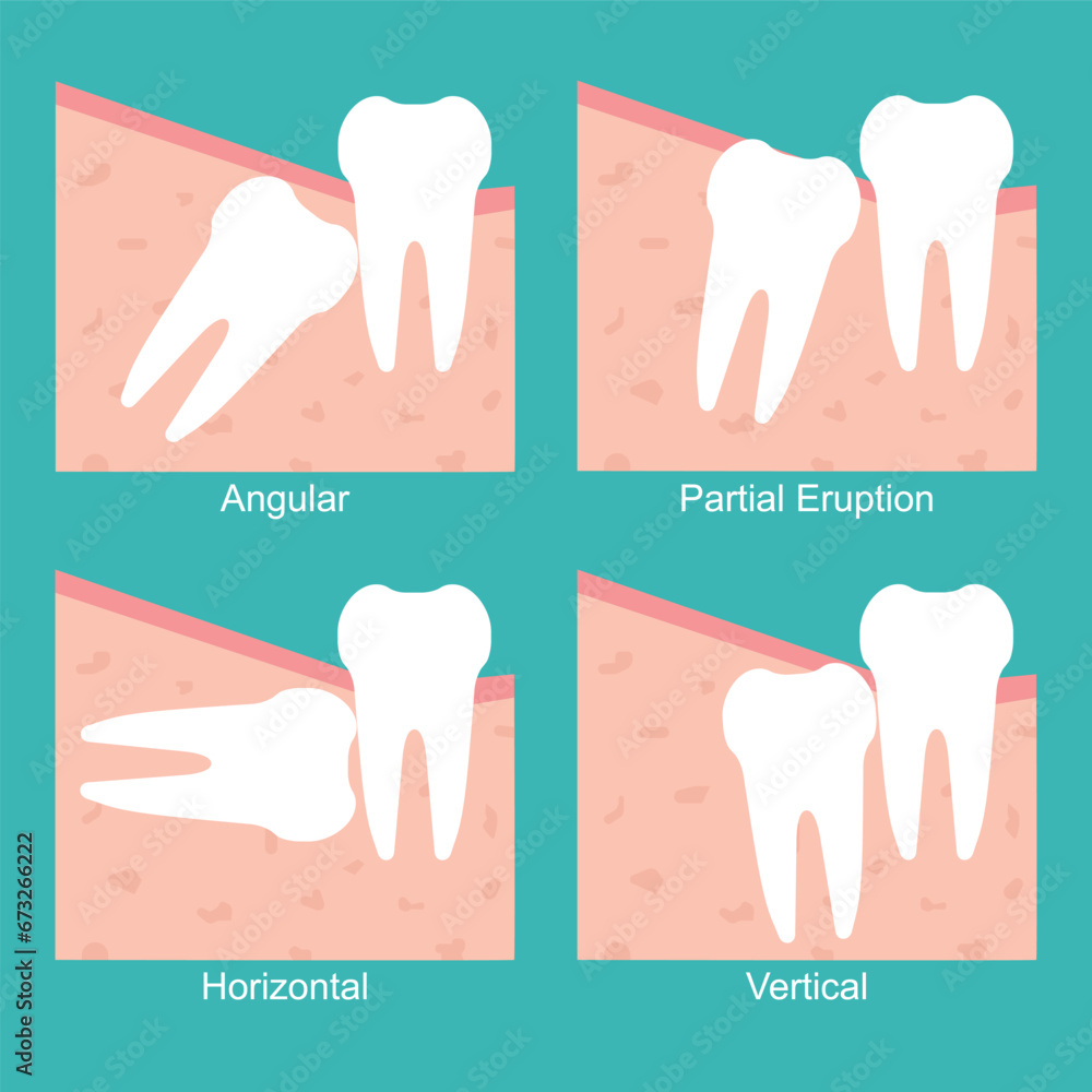Dental Classification of impacted wisdom teeth vector. Dental ...