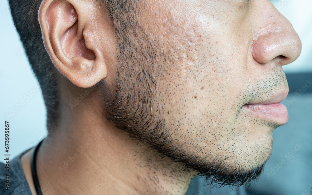 Side view of Asian man face with beard grows on his lower face. Beard ...