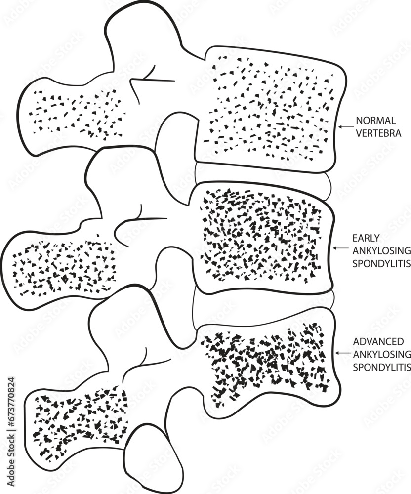 Lumbar Intervertebral Instability Line art vector illustration Stock ...