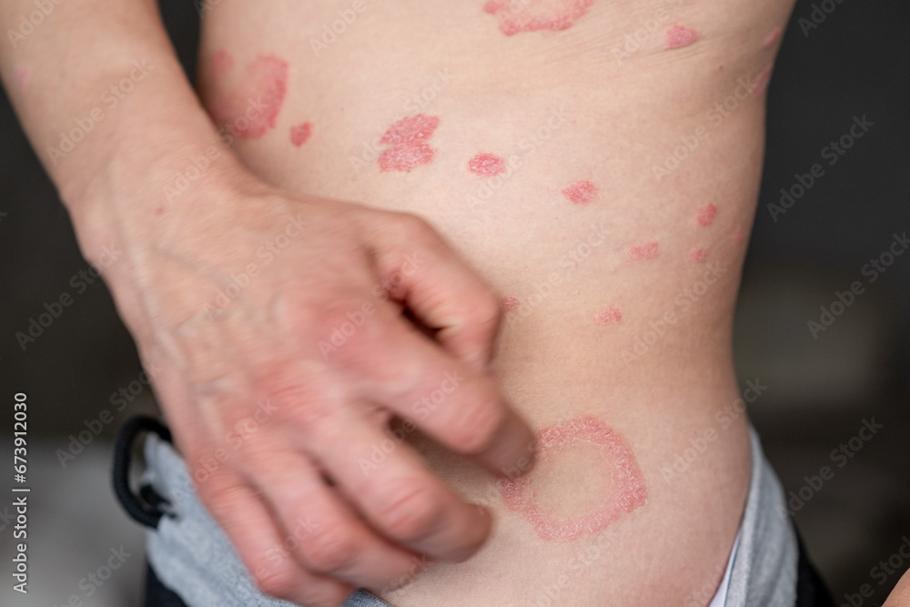 Psoriasis Vulgaris, skin patches are typically red, itchy, and scaly. Papules of chronic ...