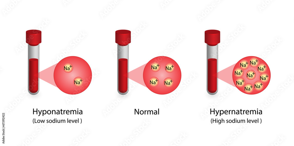 Hypernatremia, high plasma sodium level and Hyponatremia, low plasma ...